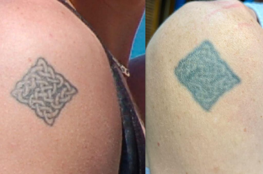 Why Do Tattoos Turn Green? - Artistic Haven